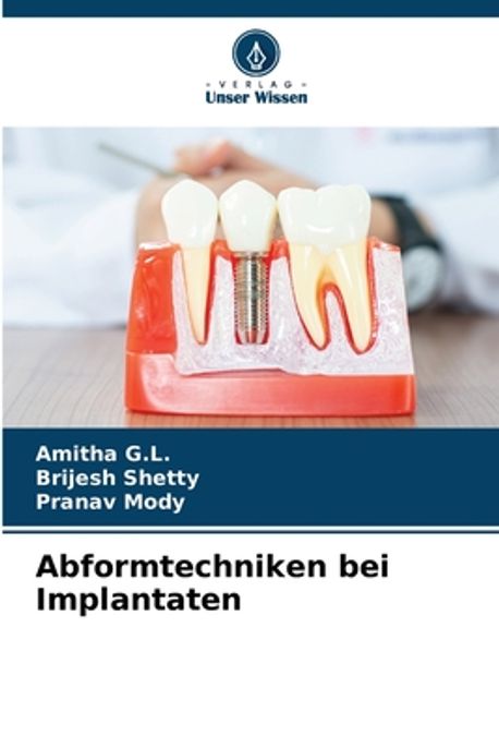 Abformtechniken bei Implantaten | G. L., Amitha - 교보문고