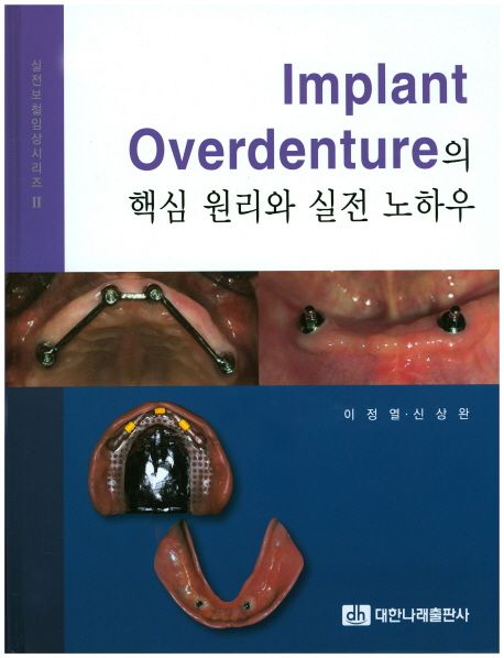 Implant Overdenture의 핵심 원리와 실전 노하우 | 이정열 - 교보문고