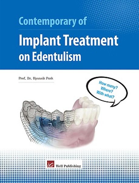 Implant Treatment on Edentulism | 박현식 - 교보문고