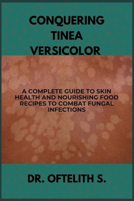 Conquering Tinea Versicolor | S, Oftelith - 교보문고